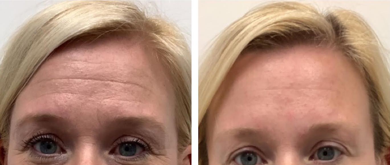 Spásný botox: 31 bodů k úlevě od migrény – Epochaplus.cz